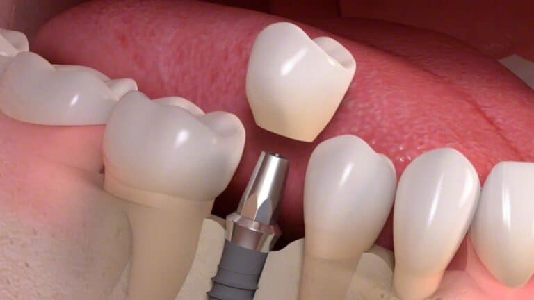 Privremeni zubni most i privremena krunica - novi osmijeh u 1 dan ...