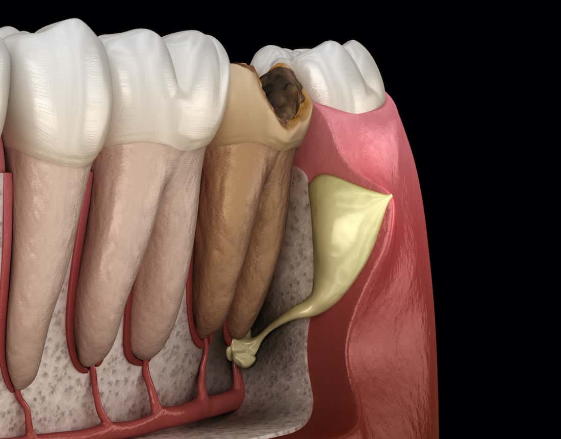 Fistula on the gums - 6 natural treatments